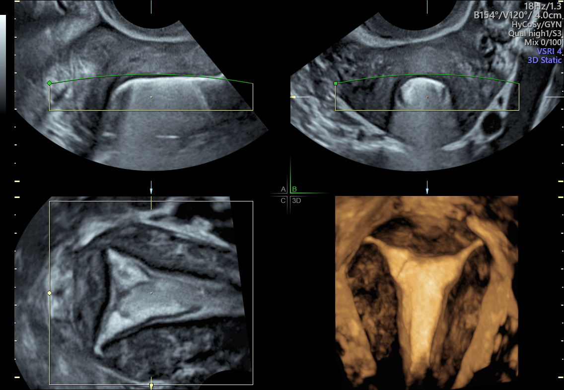 Using Hysterosonography to Assess Tubal Patency | Empowered Women's Health