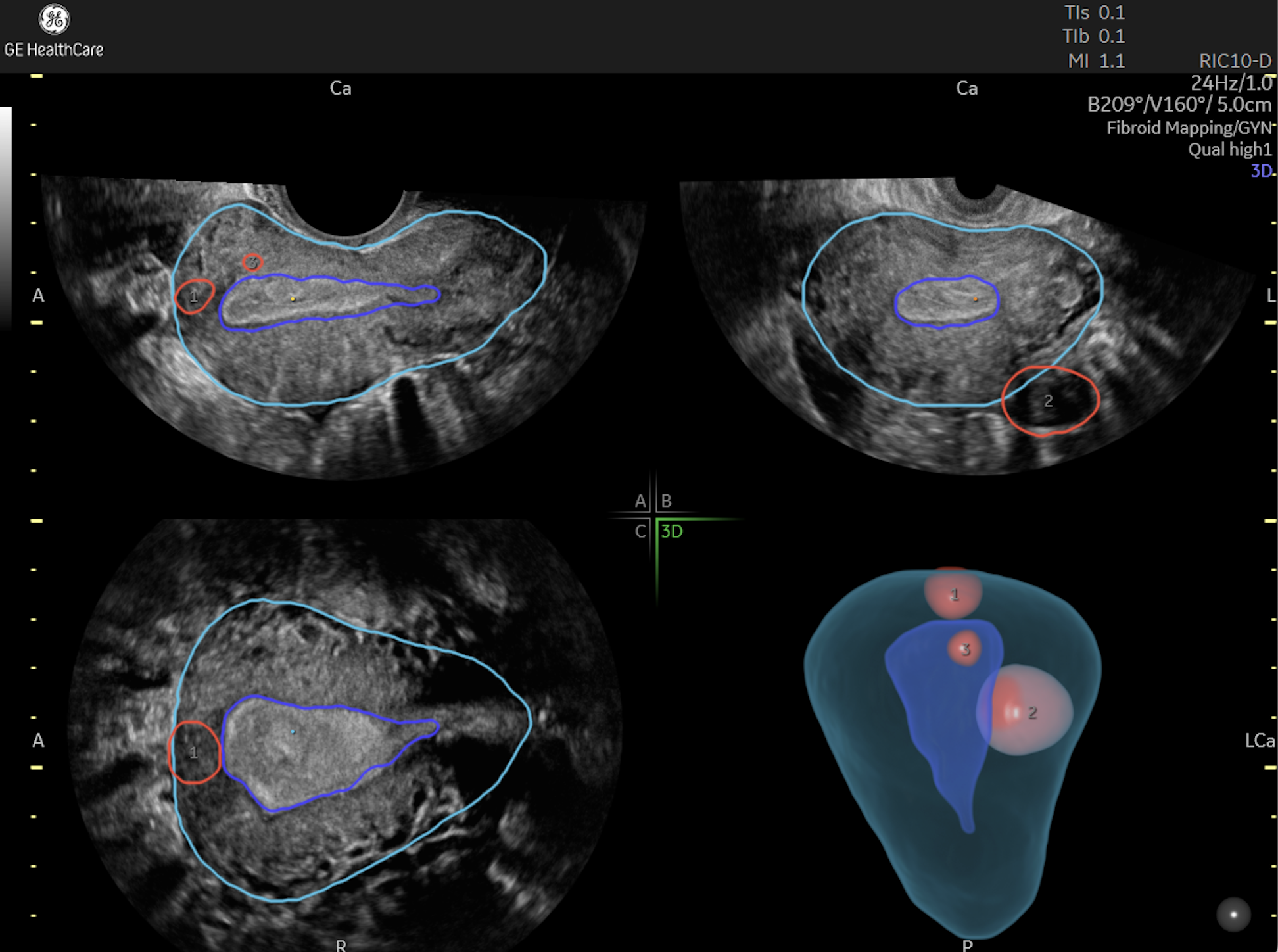 Ablation Offers More Options for Fibroids Treatment | Empowered Women's ...