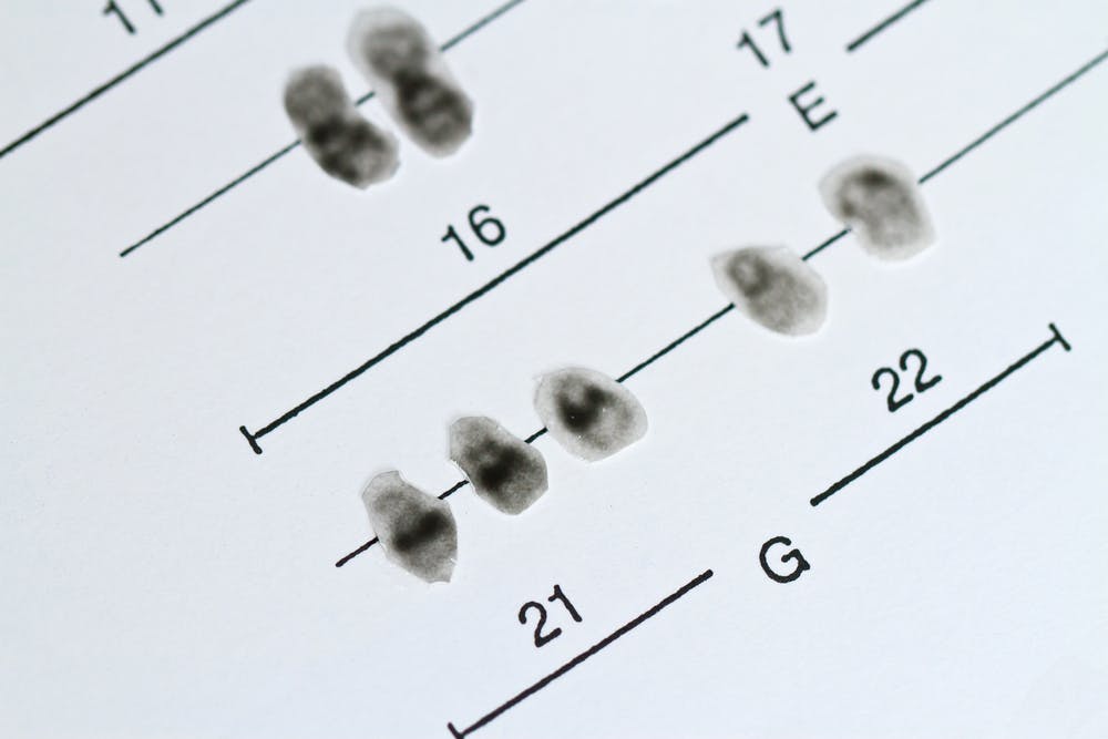 Trisomy 21 Screening: Risk Assessment in the First Trimester ...