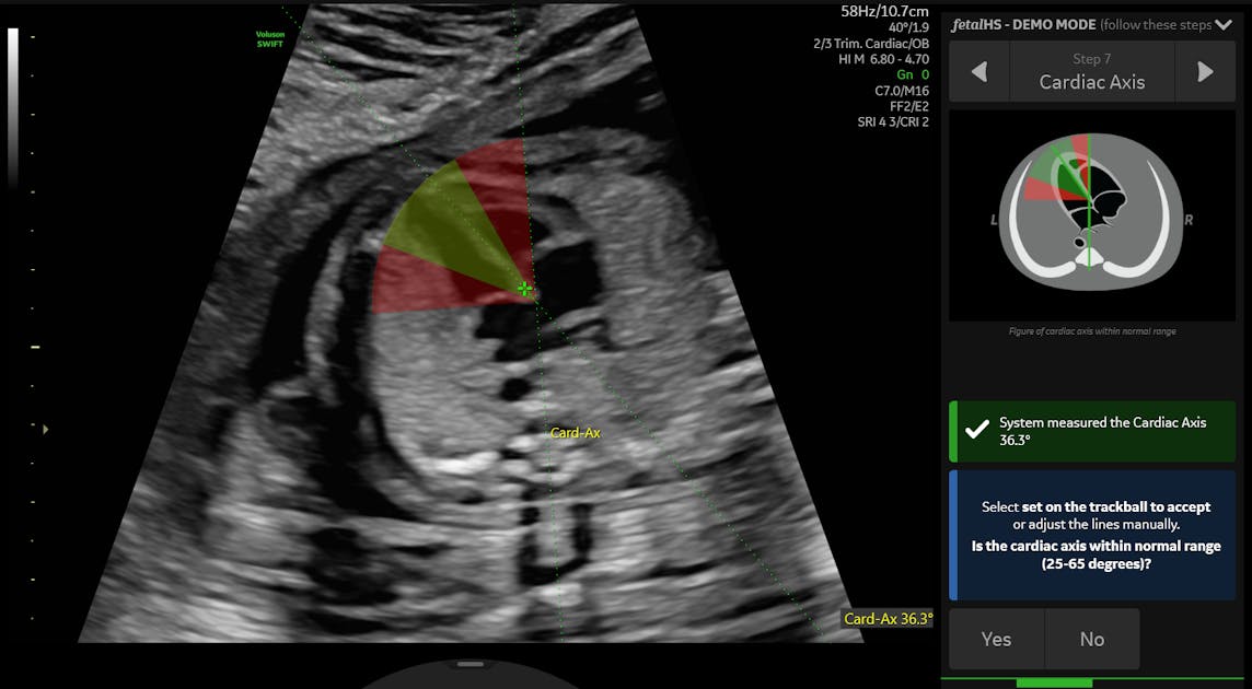 Using Ultrasound To Determine Tetralogy Of Fallot Prognosis Empowered