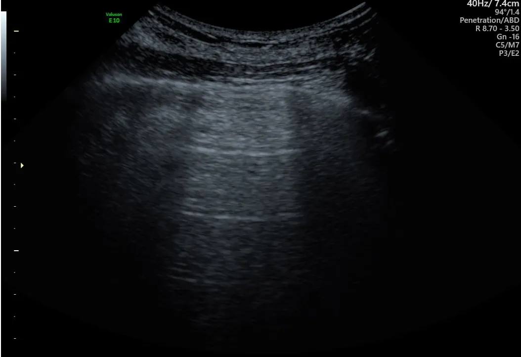 A Guide for OB/GYNs Performing Lung Ultrasounds | Empowered Women's Health