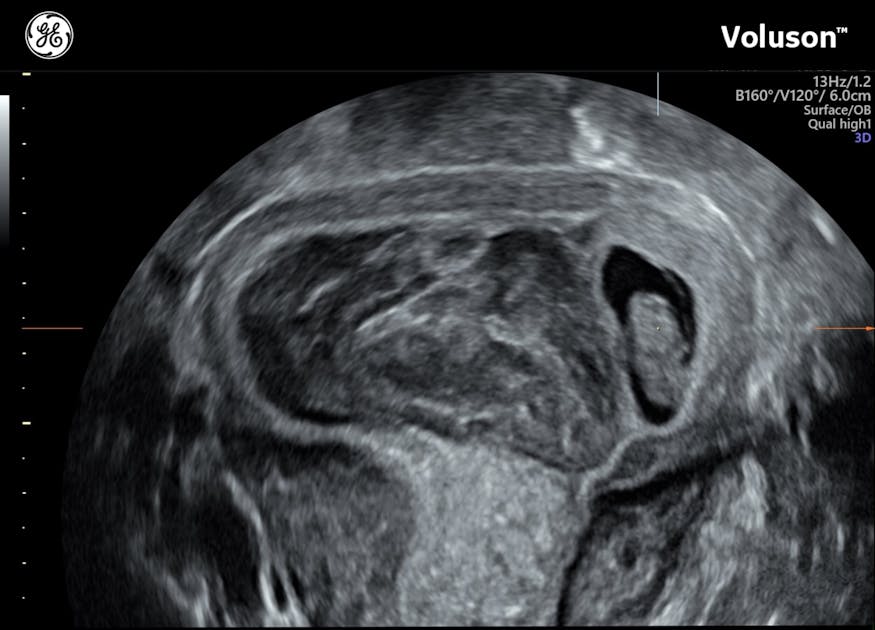 First Trimester Bleeding: What IVF Specialists Need to Know | Empowered ...