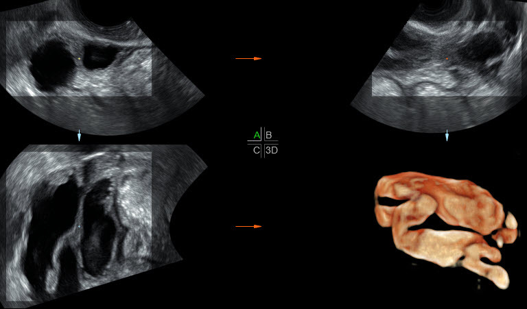 3D Ultrasound for Pelvic Inflammatory Disease Diagnosis | Empowered ...