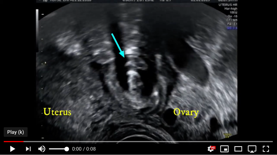 Diagnosing Pediatric Ovarian Torsion With Ultrasound Empowered Womens Health