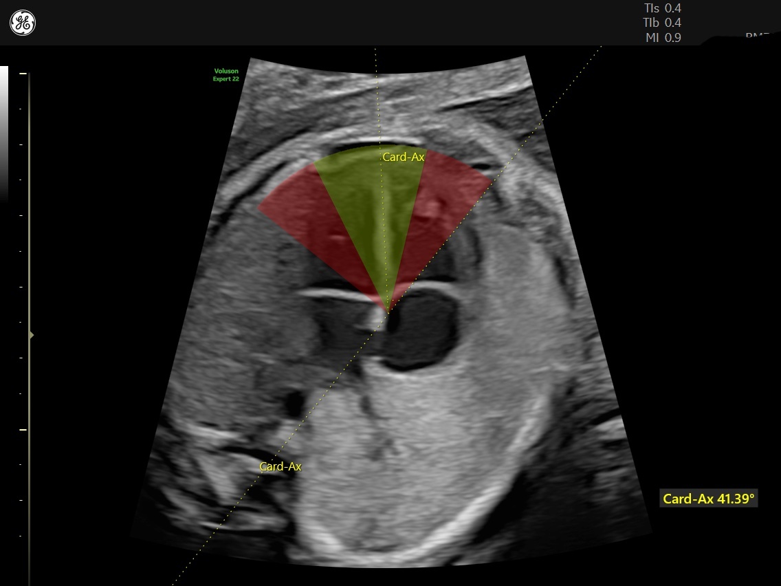 The Impact of First Trimester Ultrasound for Fetal Heart Abnormalities ...