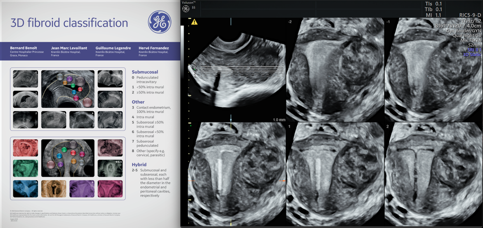 Uterine Fibroid Management and Treatment Options | Empowered Women's Health