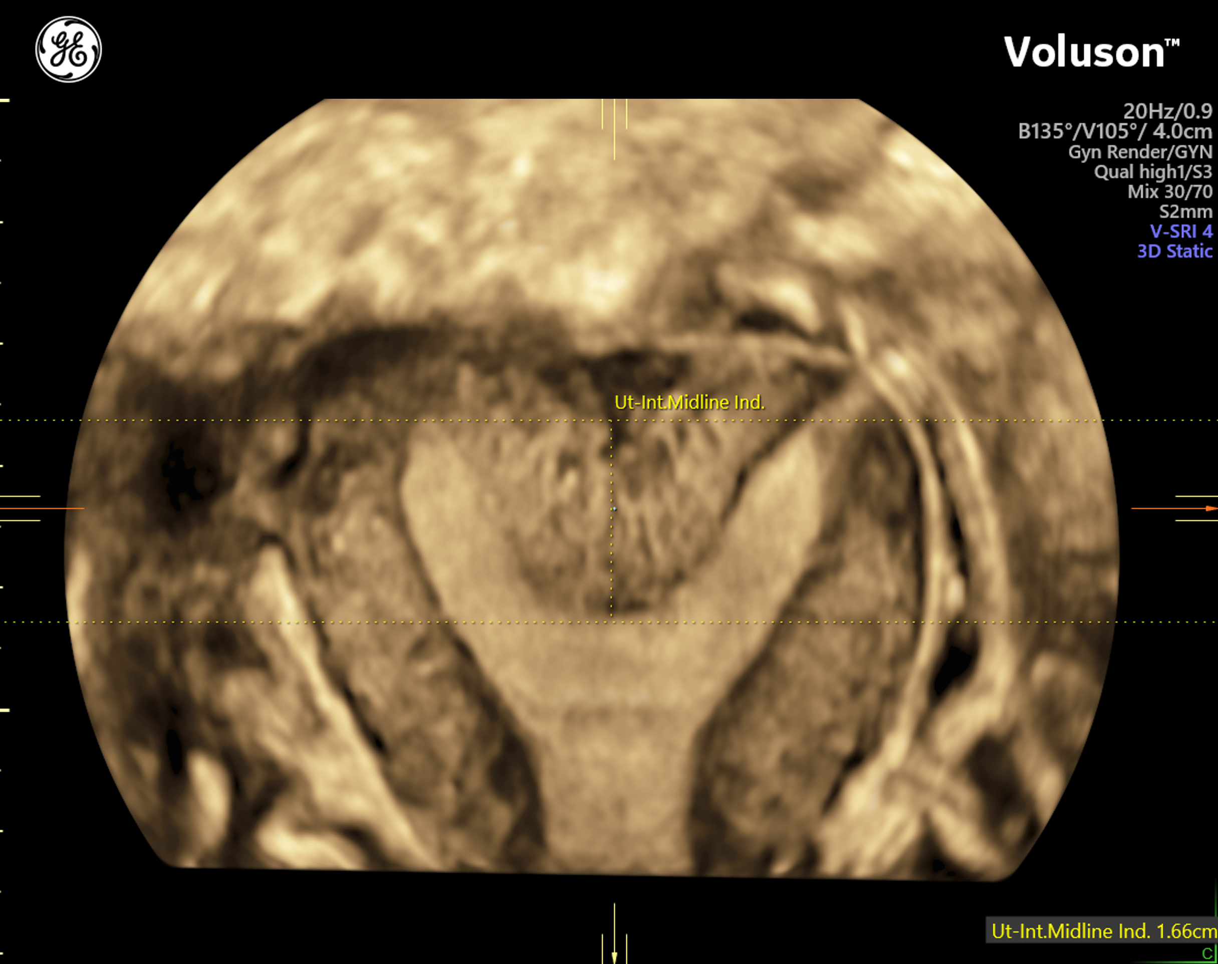 Steps in Accurately Acquiring 3D Ultrasound Volumes | Empowered Women's ...