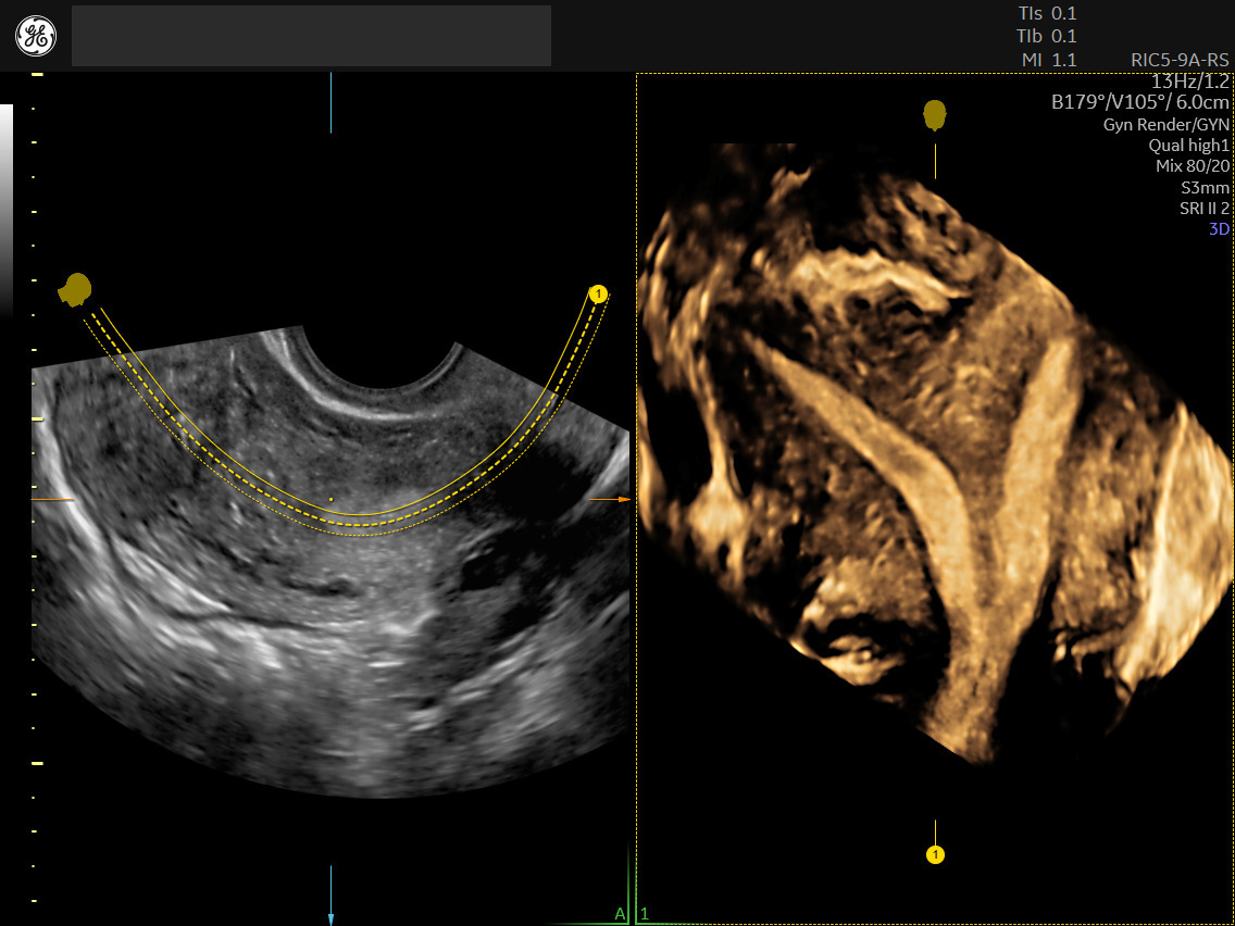 Harnessing the Power of 3D Ultrasound Technology in Gynecology ...