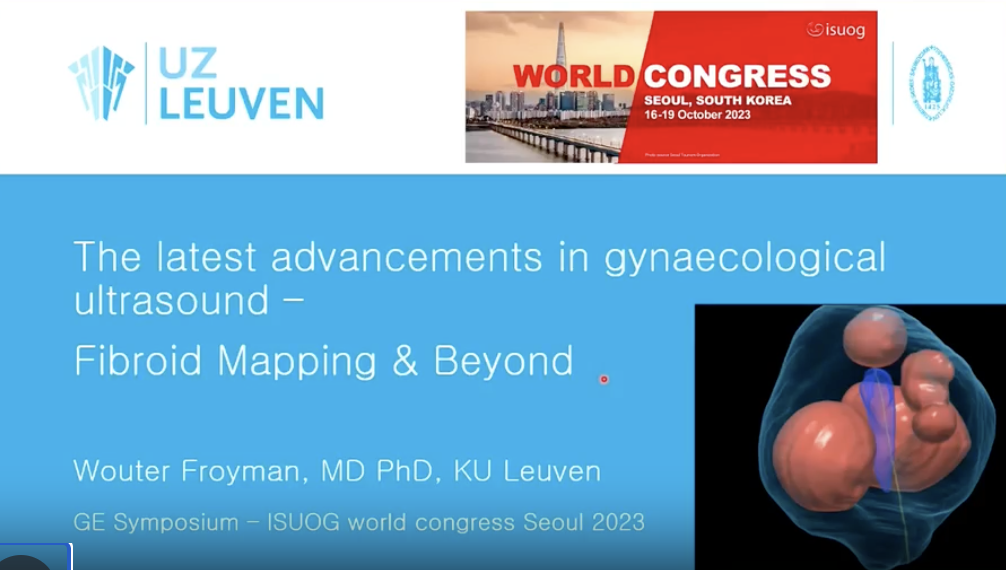 Ultrasound Fibroids Diagnostic Advancement With Fibroid Mapping