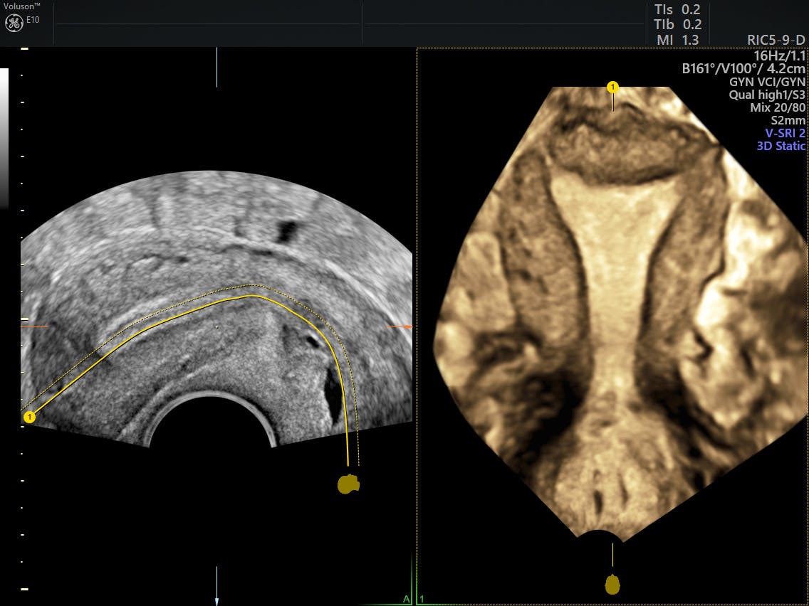 Adenomyosis Ultrasound | Empowered Women's Health
