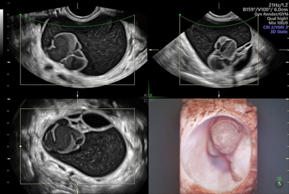 A Current Look: Biomarkers for Ovarian Cancer Screening | Empowered ...