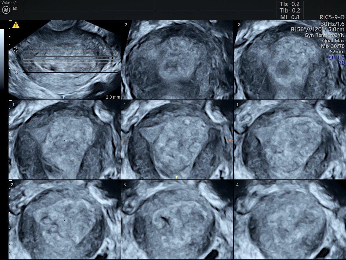 Bowel Endometriosis Ultrasound Allows Accurate and Efficient Diagnosis ...
