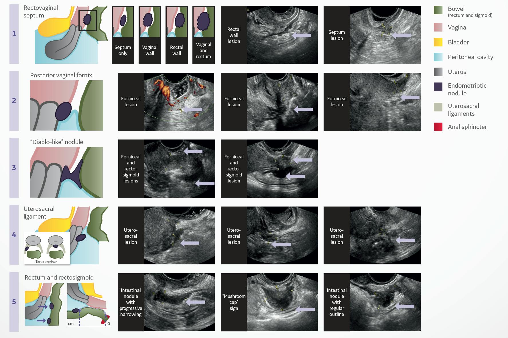 Bowel Endometriosis Ultrasound Allows Accurate and Efficient Diagnosis ...