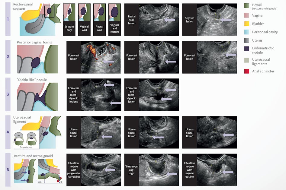 Bowel Endometriosis Ultrasound Allows Accurate and Efficient Diagnosis ...