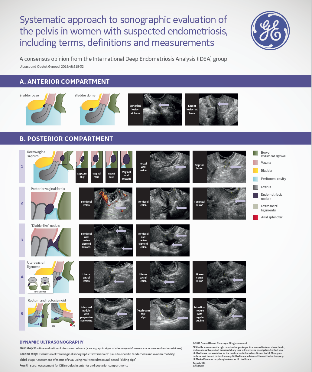 Bowel Endometriosis Ultrasound Allows Accurate and Efficient Diagnosis ...