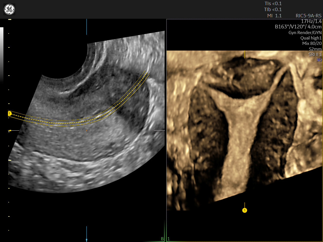 Harnessing the Power of 3D Ultrasound Technology in Gynecology ...
