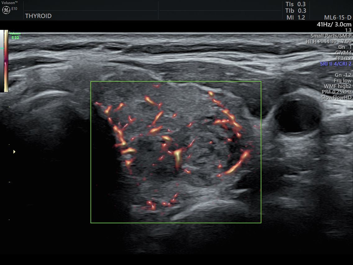Diagnosing PCOS: The Link Between Hypothyroidism and PCOS | Empowered ...