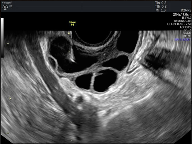 How Ultrasound-Guided Oocyte Retrieval Can Be Less Painful | Empowered ...