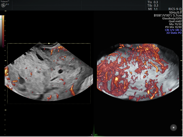 Understanding Enhanced Myometrial Vascularity | Empowered Women's Health