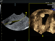 Endometrial Polyp Ultrasound SIS The Gold Standard Empowered Women