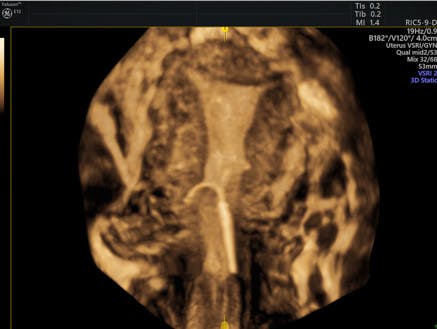 IUD Insertion with Ultrasound | Empowered Women's Health