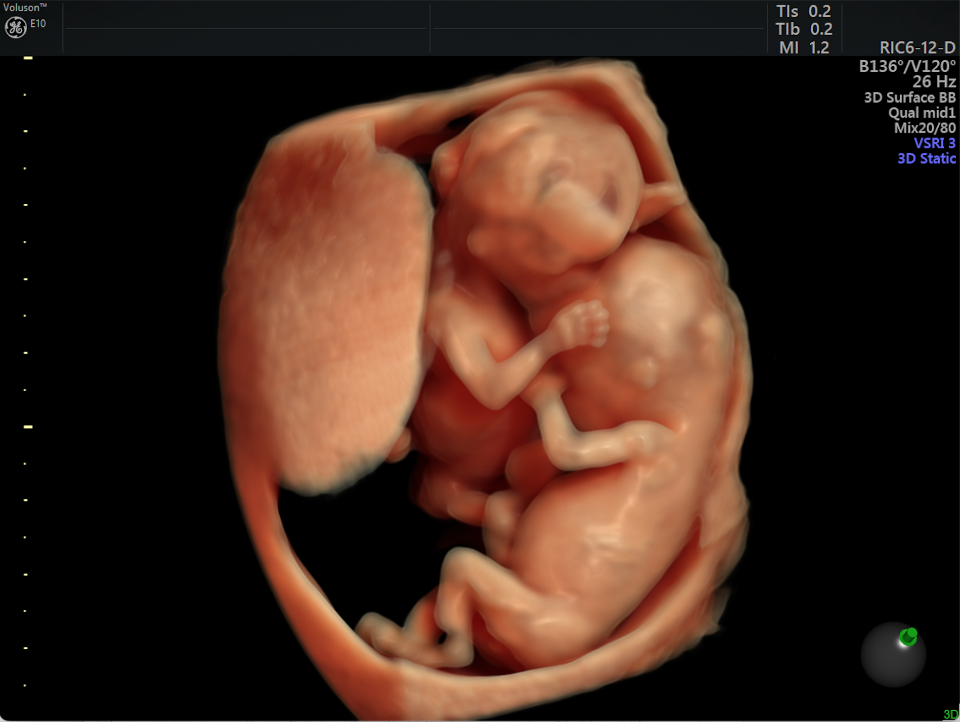 Identical Twins In The Same Sac 6 Weeks Pregnant Ultrasound Of Twins