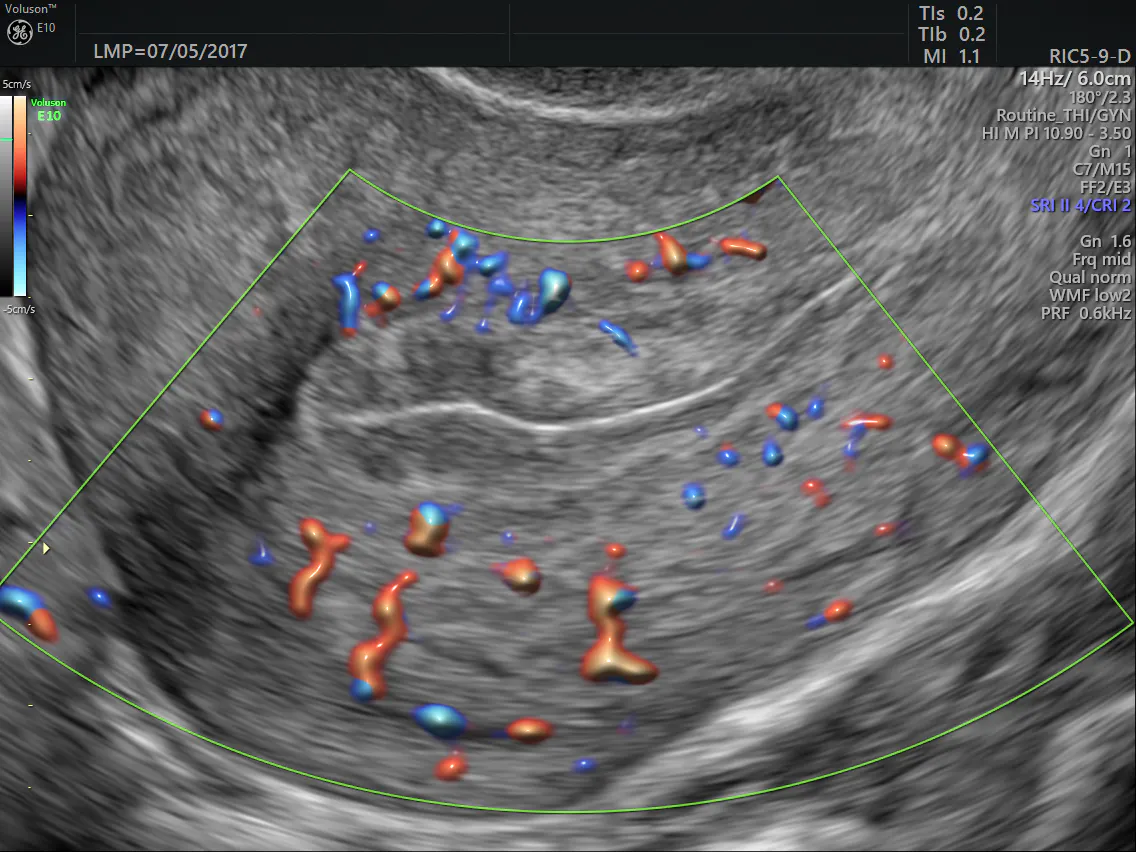 3D Ultrasounds Can Transform Postmenopausal Gynecology | Empowered ...