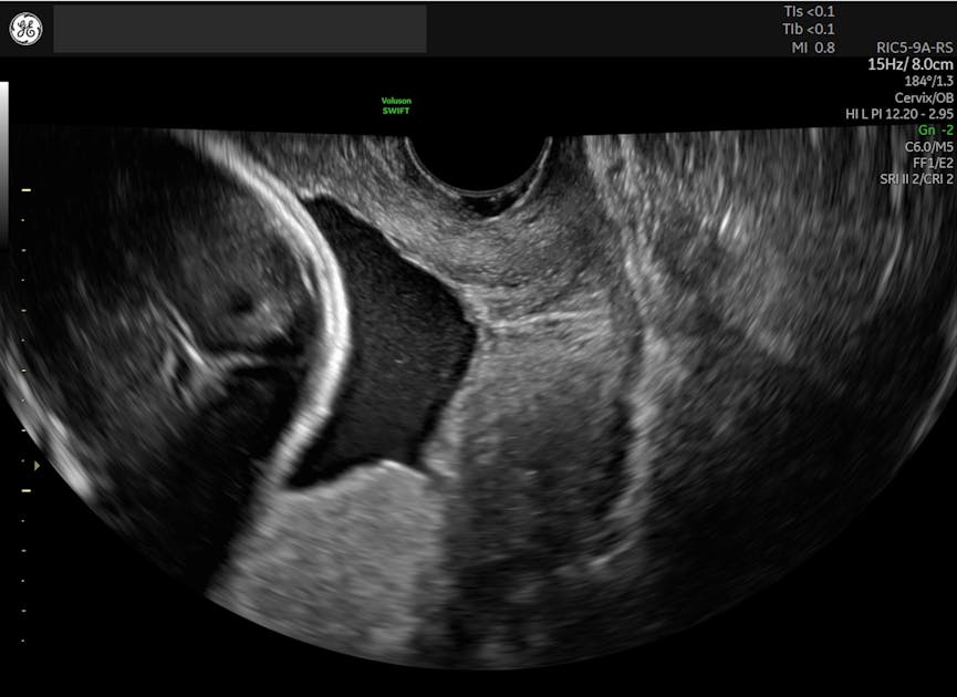 Understanding the Importance of Measuring Cervical Length | Empowered ...