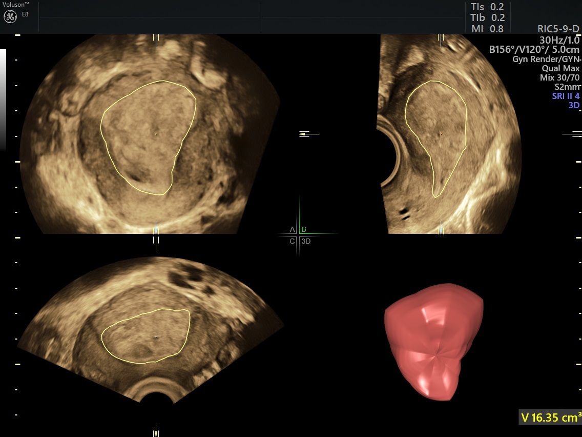 3 Embryo Transfer Factors That May Affect Its Success | Empowered Women ...