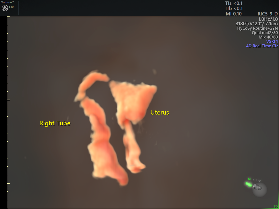 Subfertility & Infertility: Do Patients Know the Difference ...