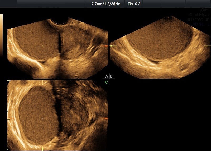 Endometriosis Diagnosis | Empowered Women's Health