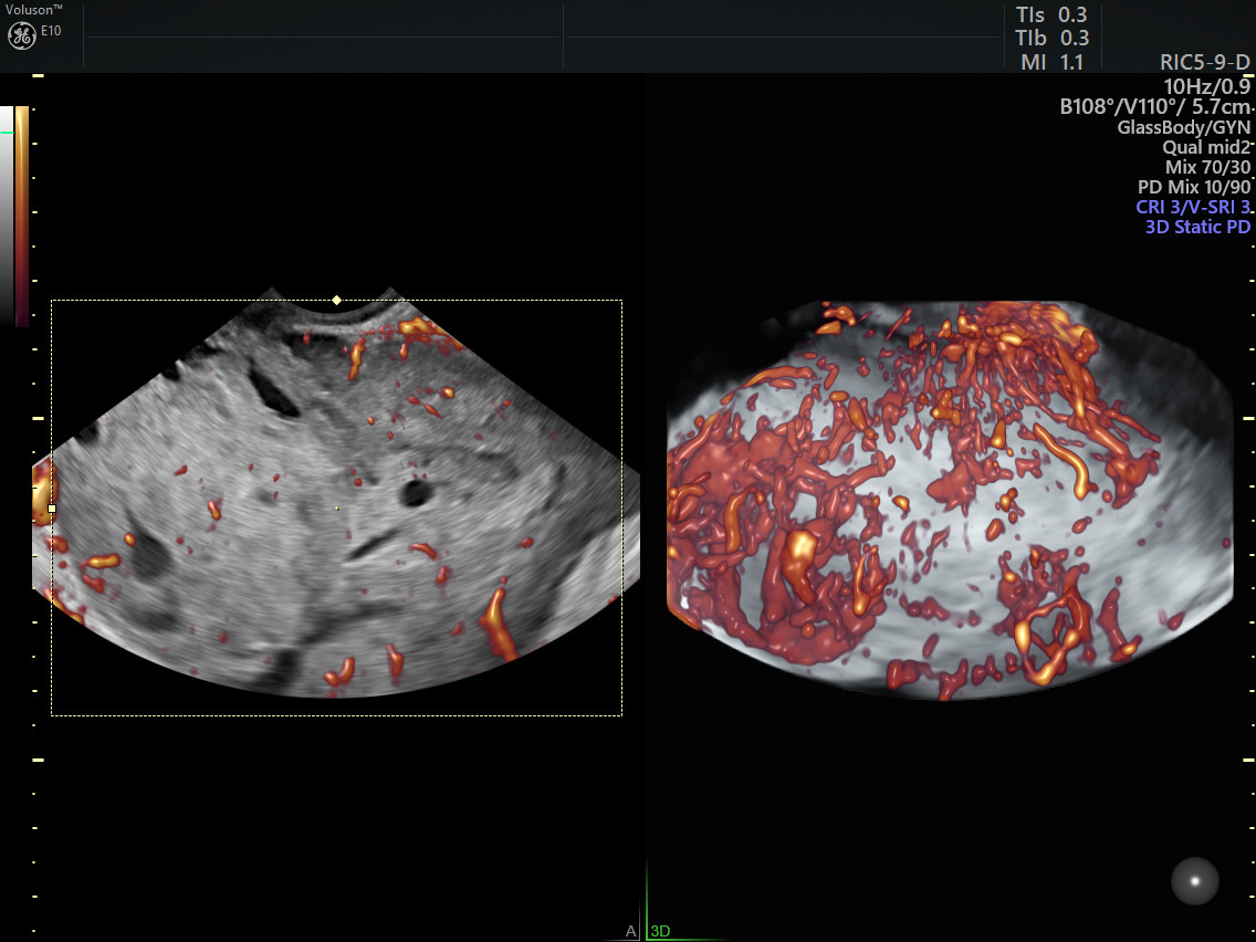 Adenomyosis and Ultrasound: Diagnosis and Treatment Options | Empowered ...