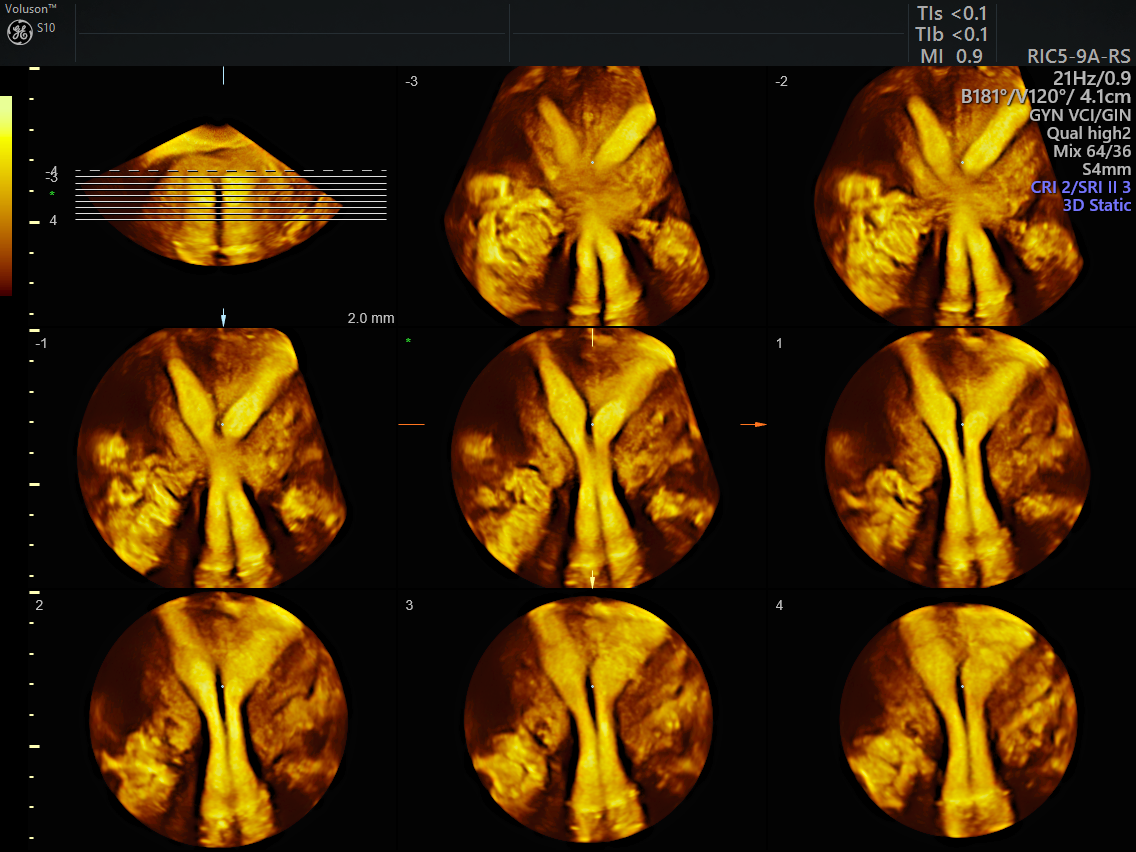 How to Diagnose Uterine Anomalies | Empowered Women's Health