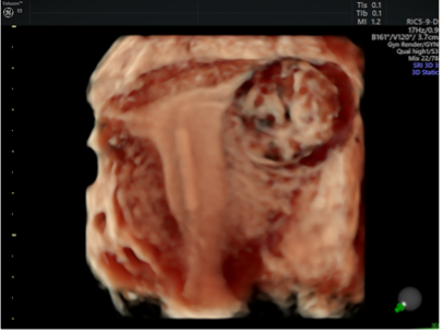 Steps in Accurately Acquiring 3D Ultrasound Volumes | Empowered Women's ...