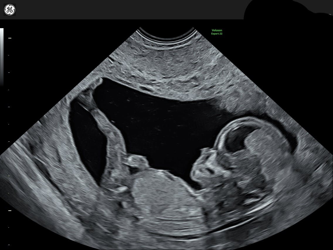 A Guideline-Based Approach to First-Trimester Ultrasound | Empowered ...