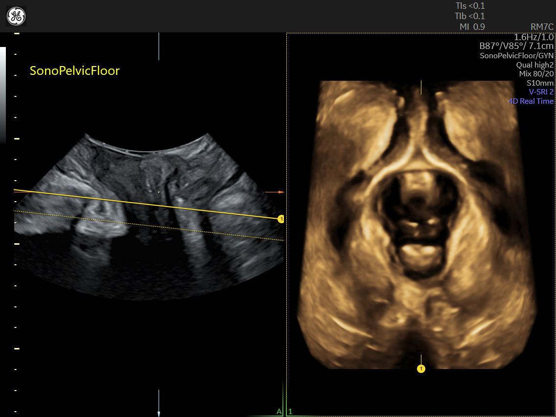 Benefits of 3D Pelvic Floor Ultrasound in Assessing Injuries ...
