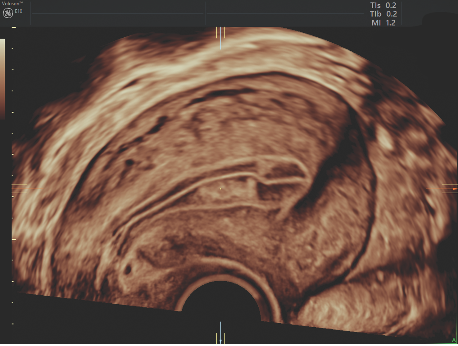 Abnormal Transvaginal Ultrasound Polyps