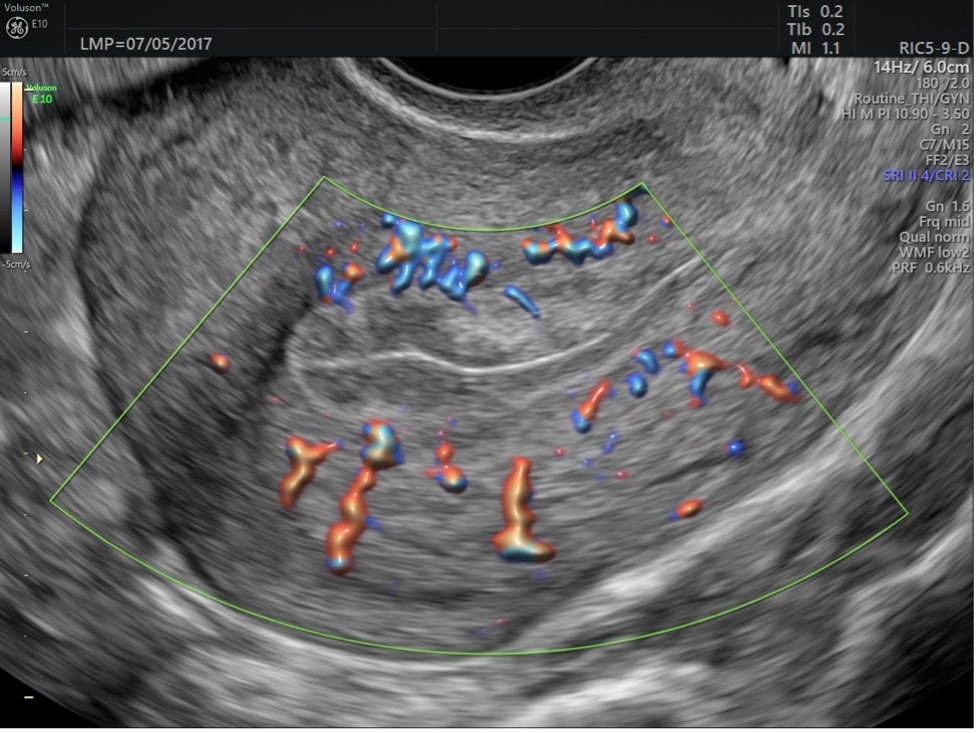 Understanding Enhanced Myometrial Vascularity | Empowered Women's Health