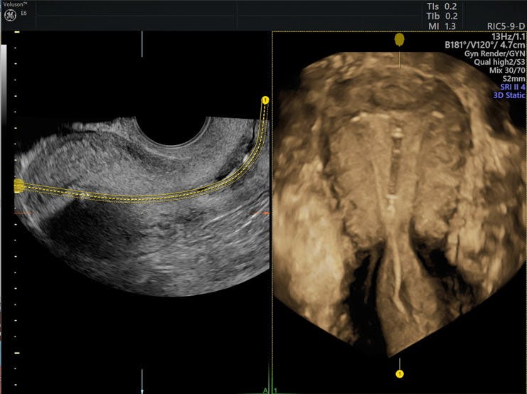 IUD Insertion with Ultrasound | Empowered Women's Health
