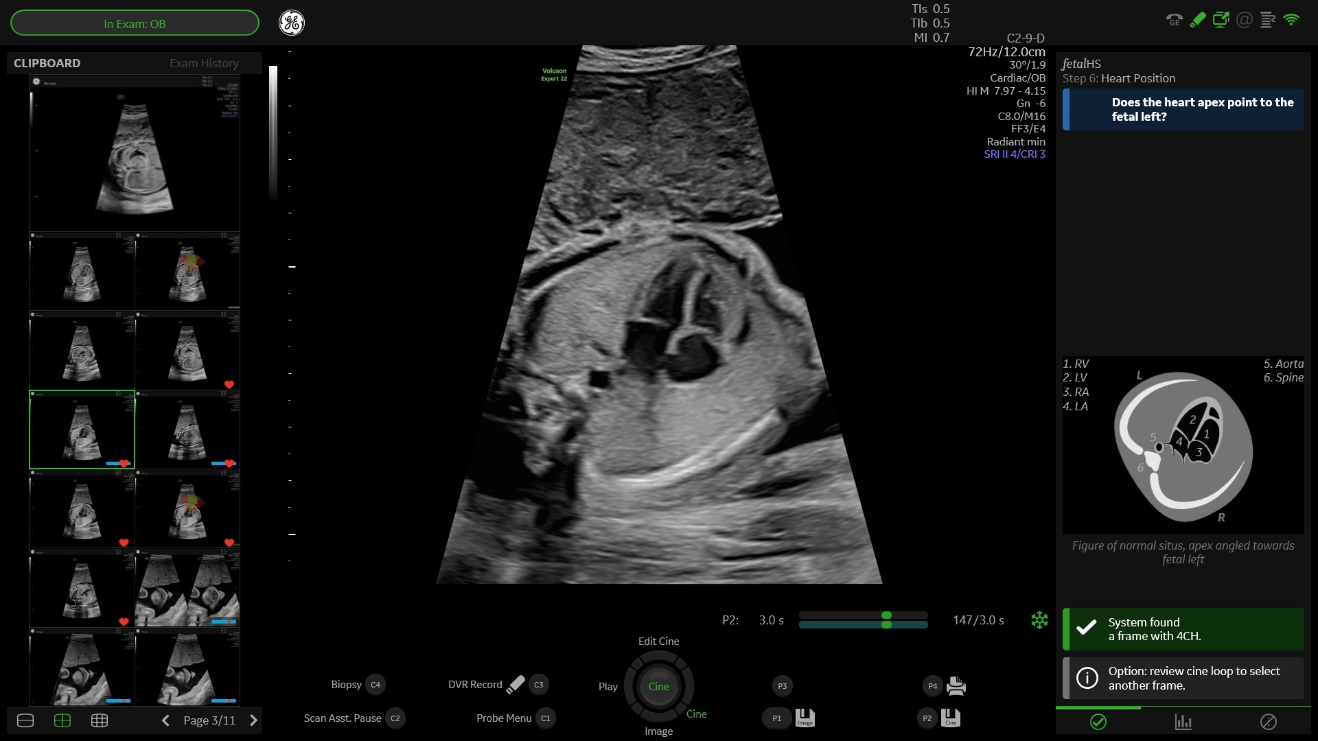 Ultrasound Fetal Heart Defects Utilizing Fetal Heart Ultrasound For