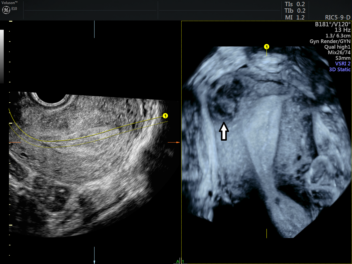 The Benefits of 3D Ultrasound in Gynecology | Empowered Women's Health