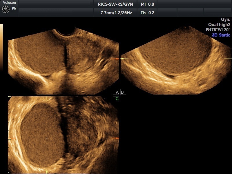 Level 2 Ultrasound & Diagnosing Chronic Pelvic Pain | Empowered Women's ...