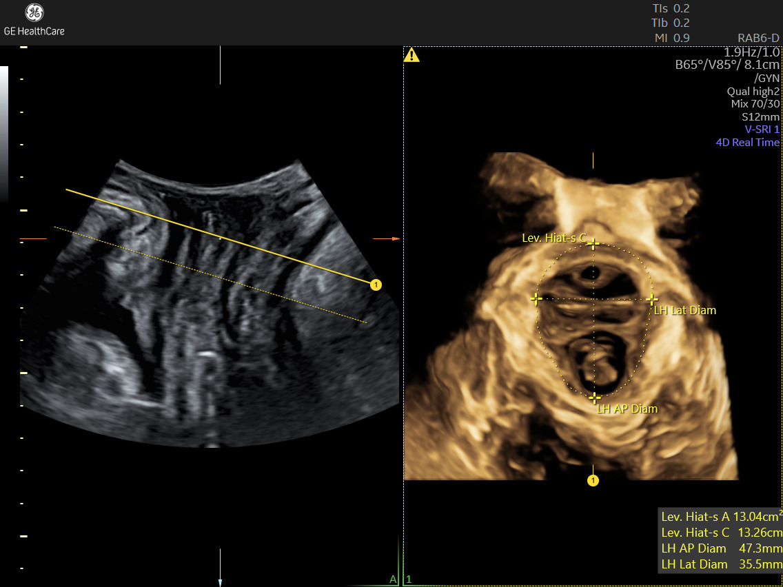 Benefits of 3D Pelvic Floor Ultrasound in Assessing Injuries ...