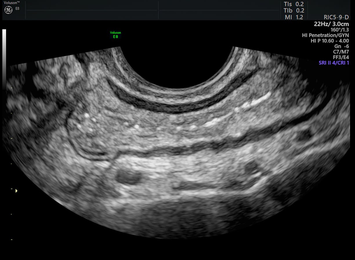 Endometriosis & Crohn's: How to Diagnose Stomach Pain | Empowered Women ...