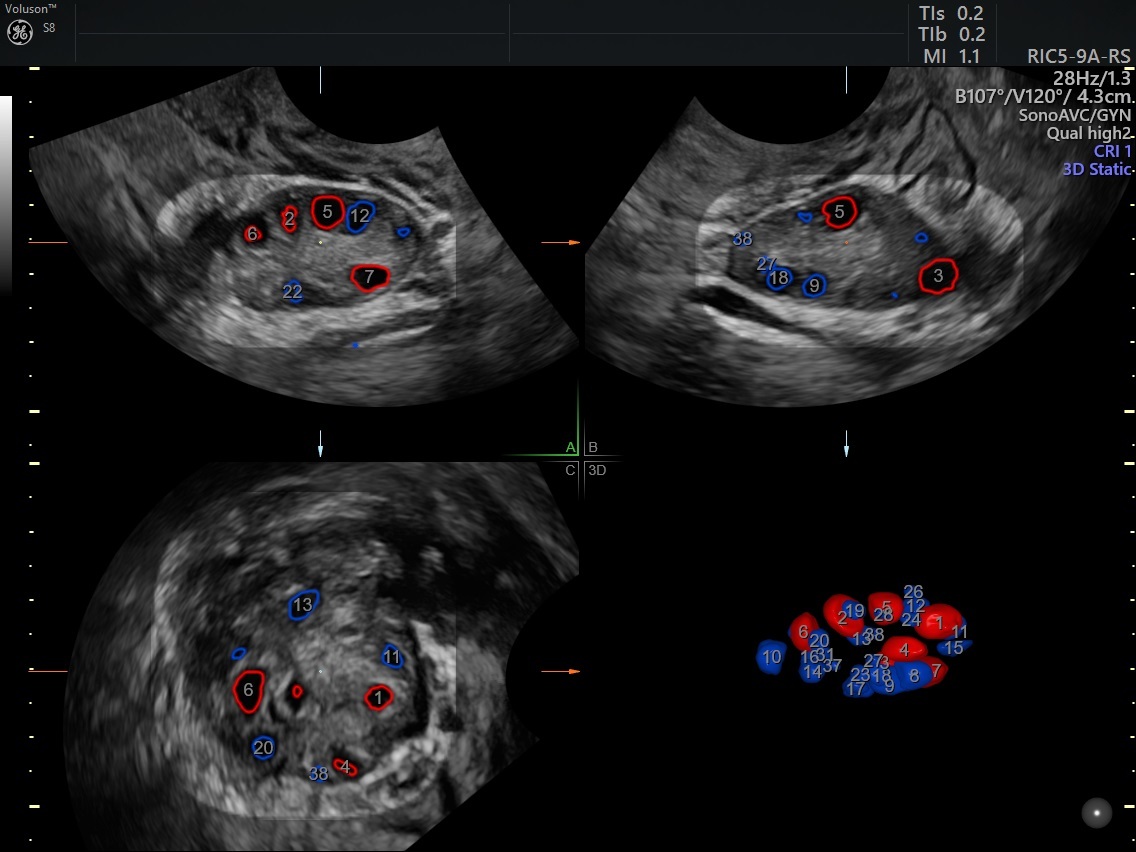 Antral Follicle Count Ultrasound | The Role of 3D Imaging | Empowered ...