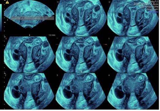 Steps in Accurately Acquiring 3D Ultrasound Volumes | Empowered Women's ...