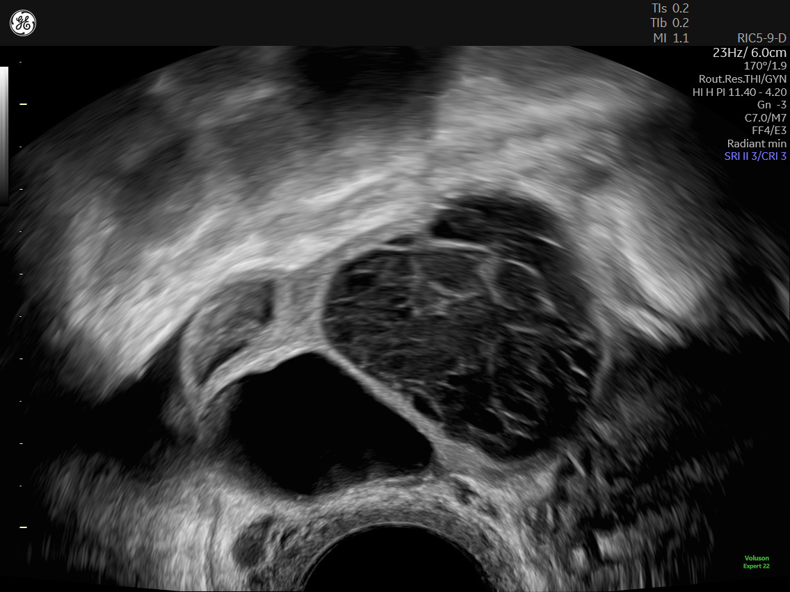 Bowel Endometriosis Ultrasound Allows Accurate and Efficient Diagnosis ...