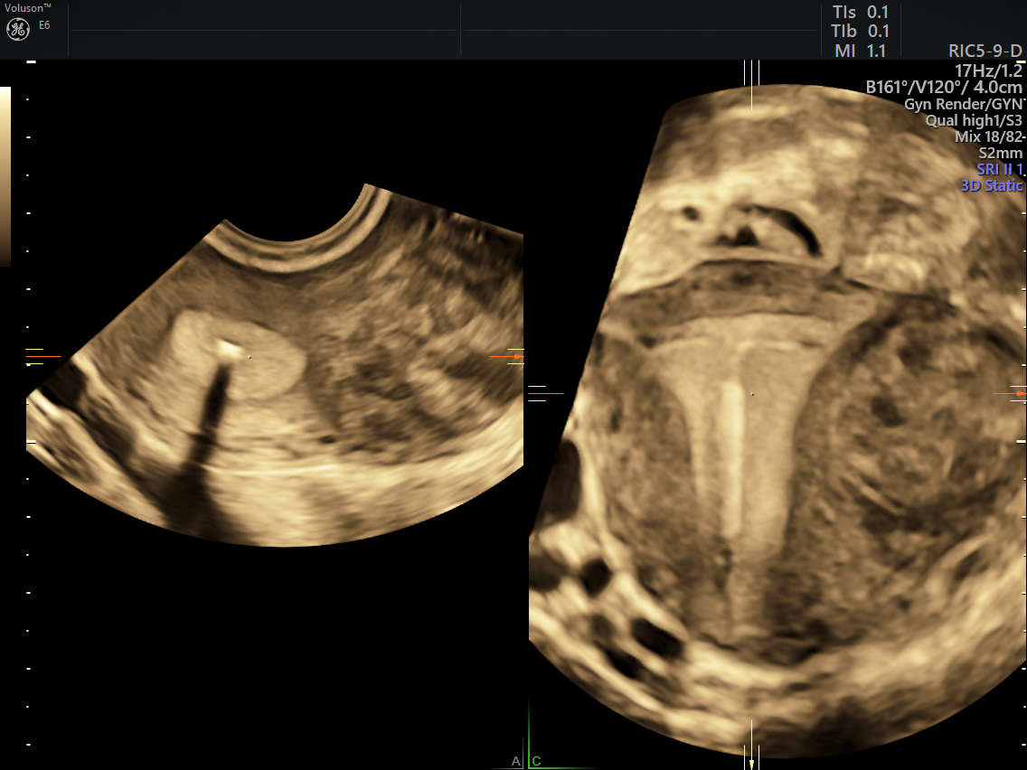 RFA and Ultrasound Treatment for Fibroids | Empowered Women's Health