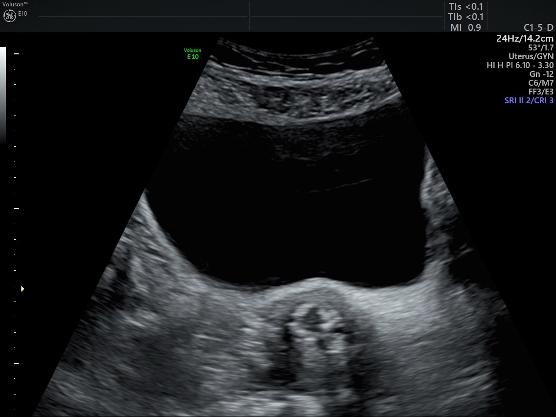 Using 3D Ultrasound in Overactive Bladder Assessments | Empowered Women ...