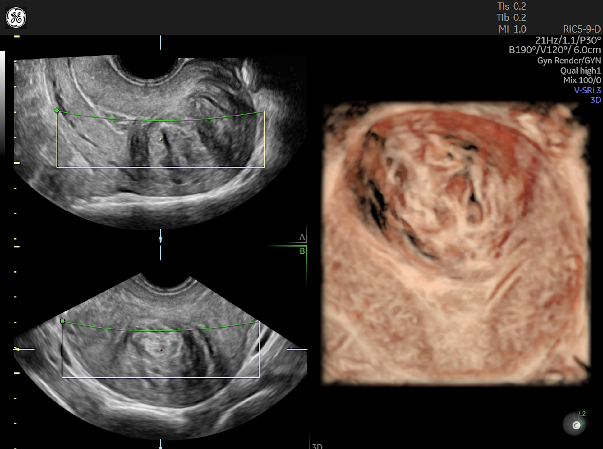 Ablation Offers More Options for Fibroids Treatment | Empowered Women's ...